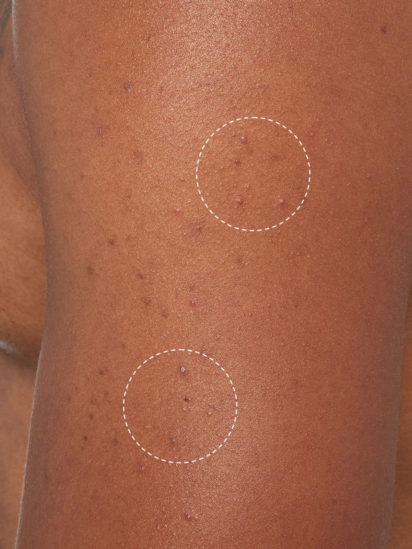 Body Breakout Patches (6pk) - Body Acne Spot Dots