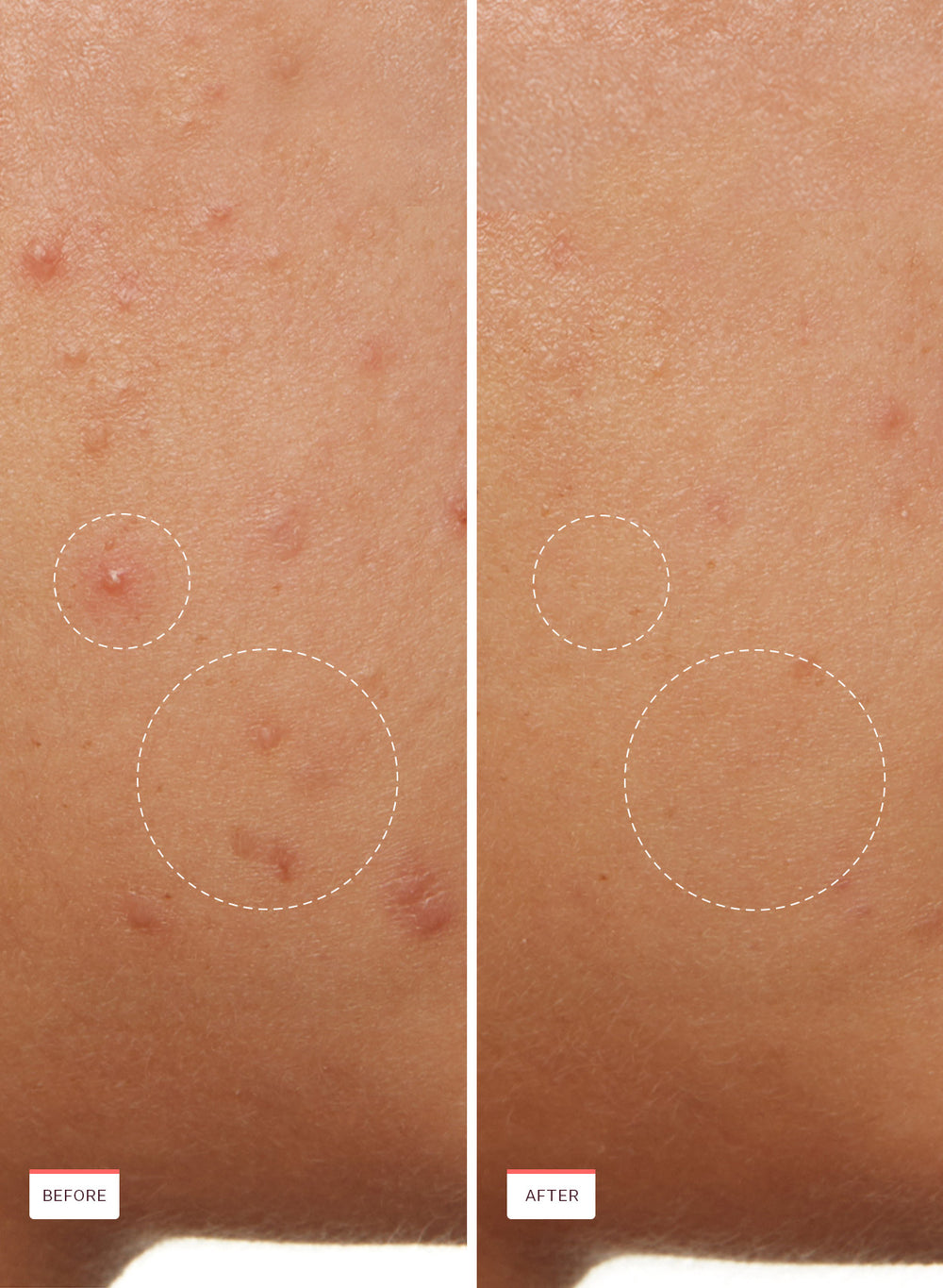 Peach Slices Acne Clarifying Cleanser - Gentle Wash