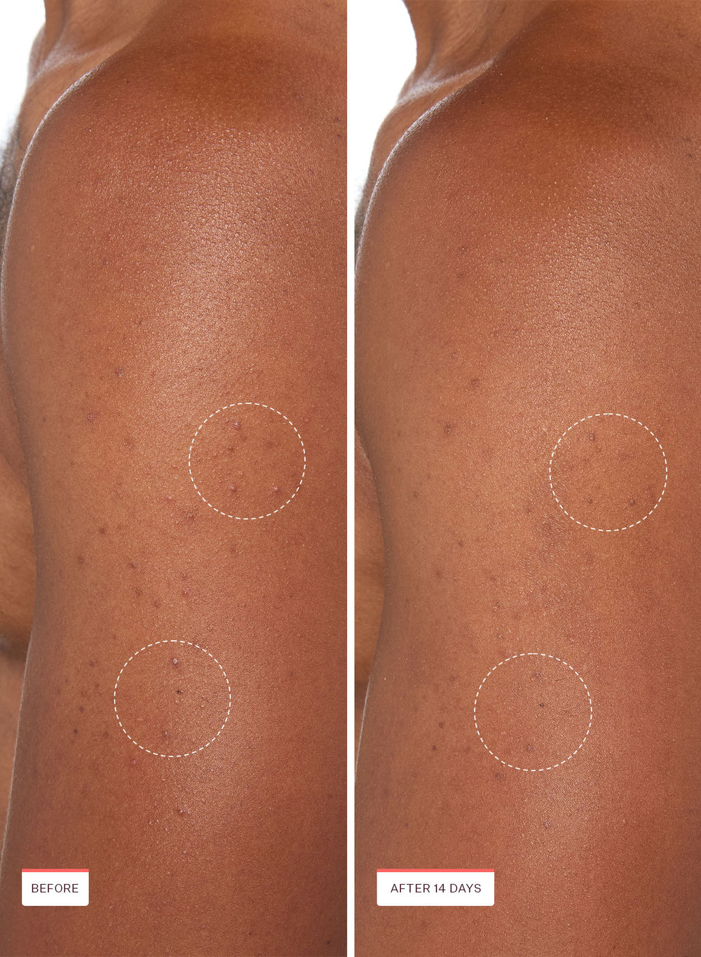 Body Breakout Patches (6pk) - Body Acne Spot Dots